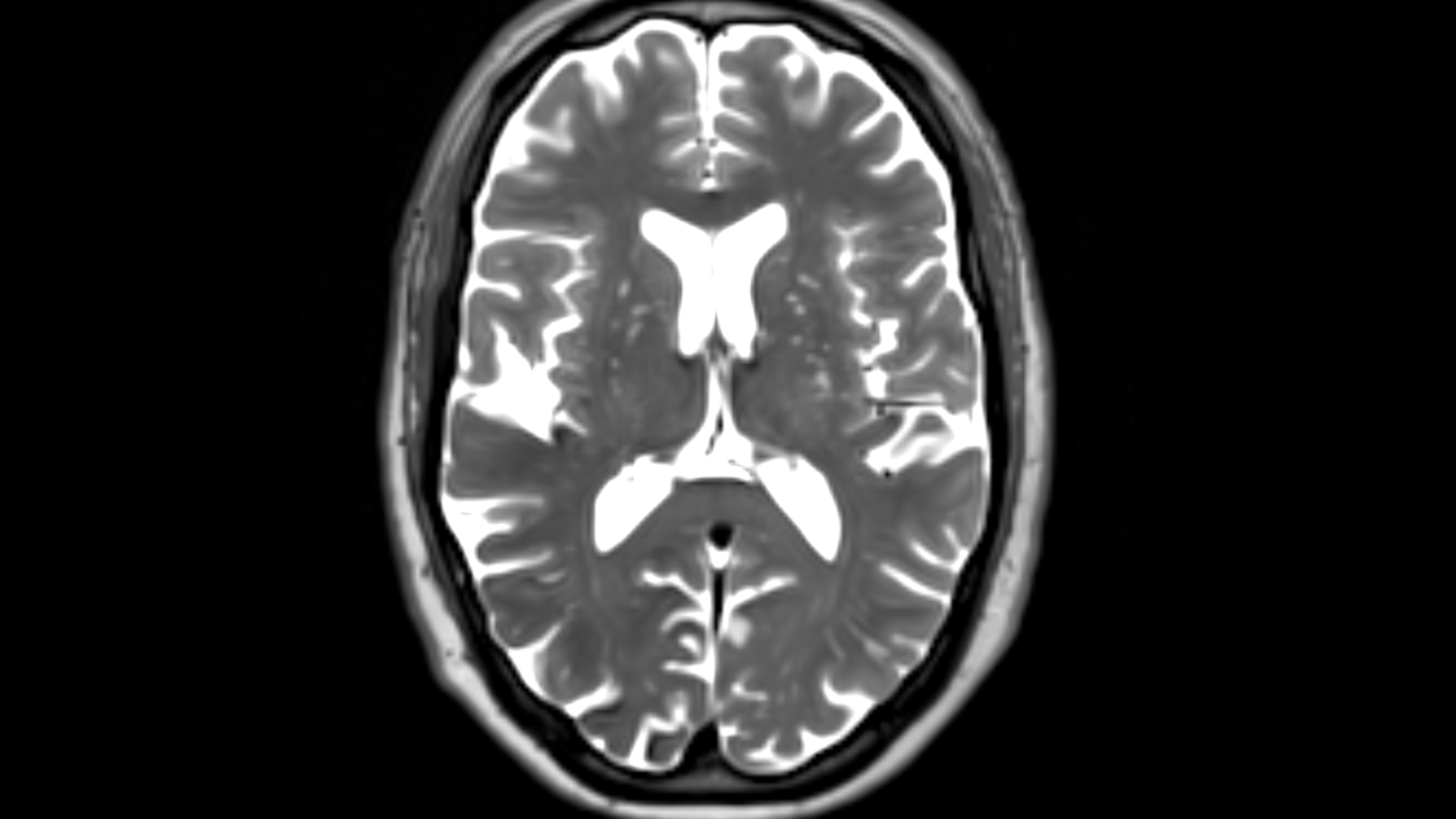 Anatomical Imaging | Neuroimaging - The University of Iowa