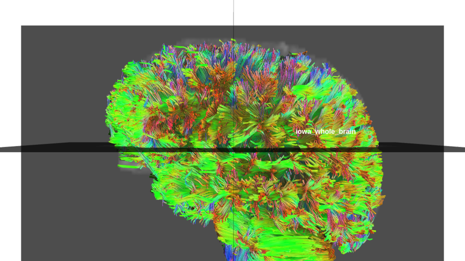 Diffusion Imaging | Neuroimaging - The University of Iowa